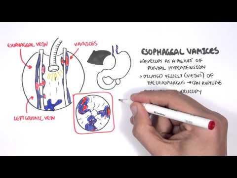 Upper GI Bleed Causes- Overview