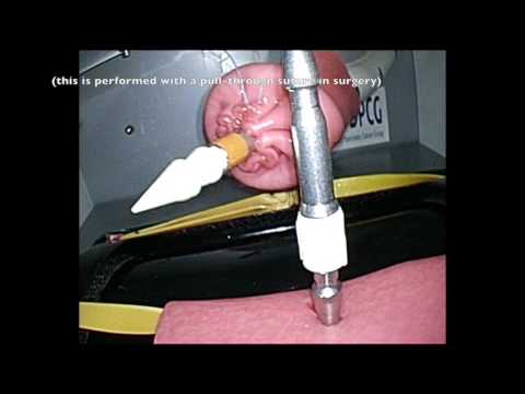 Laparoscopic Circular Stapler (Surgical Anastomosis)