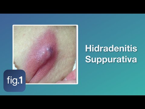 What is Hidradenitis Suppurativa?