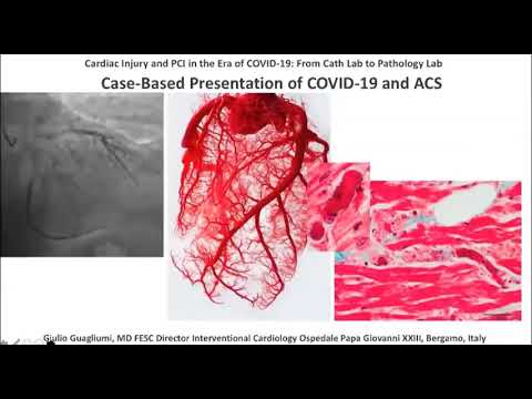 Case Based Presentation of COVID 19 and ACS presented by Dr. Guilio Guagliumi