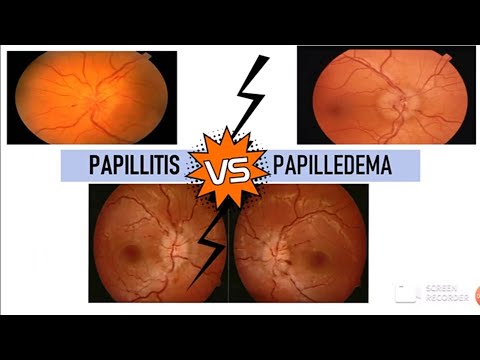 PAPILLITIS v/s PAPILLEDEMA