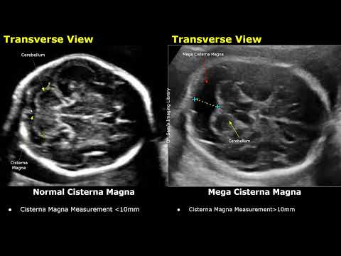 Edwards Syndrome (Trisomy 18) Antenatal Ultrasound Features | Fetal USG Normal Vs Abnormal Images