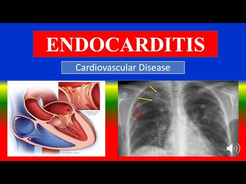 ENDOCARDITIS - Definition, types, causes, pathophysiology, symptoms , diagnoses , medicine