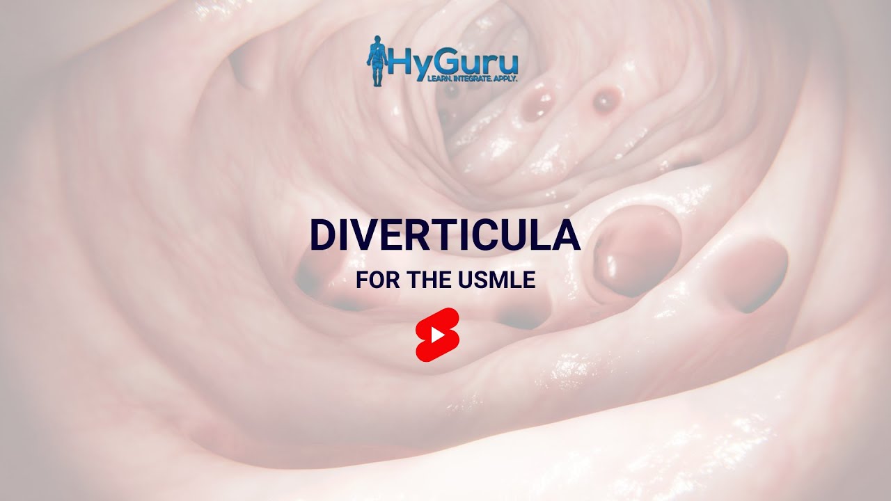 Diverticula for the USMLE | HyGuru