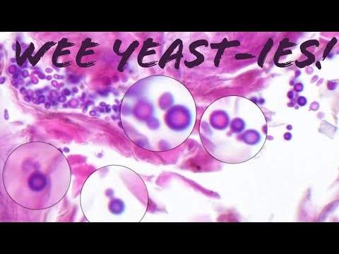 Yeast Skin Fungus (Malassezia/Pityrosporum incidental in actinic keratosis - not yeast infection)