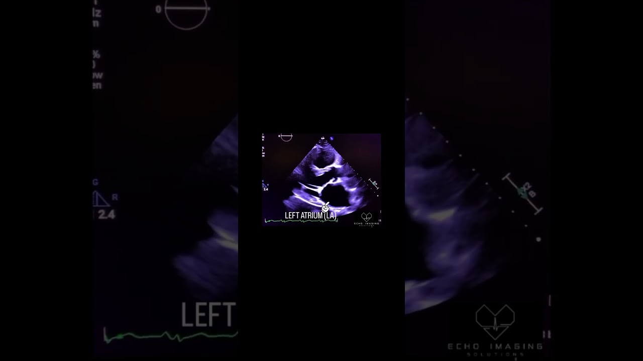 What Do We See in the Parasternal Long Axis View? #echocardiography #cardiology #echocardiogram