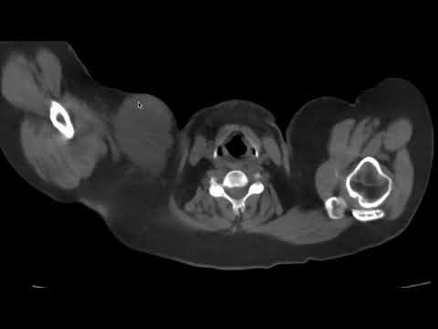 Phyllodes tumor or Cystosarcoma phyllodes