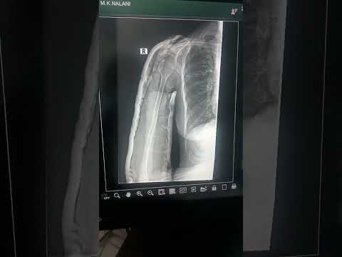 R humerus fracture