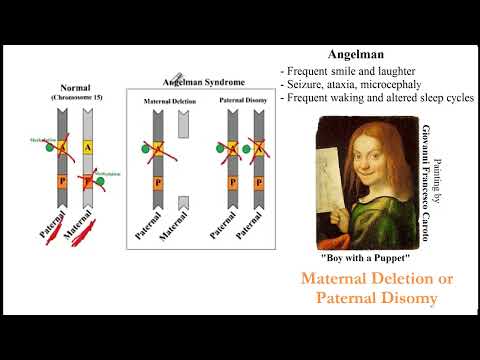USMLE ACE Video 28: Genetic Terminologies, Angelman and Prader-Willi Syndromes