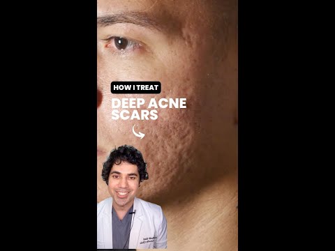 The *BEST* Way to Treat Deep Acne Scars✨