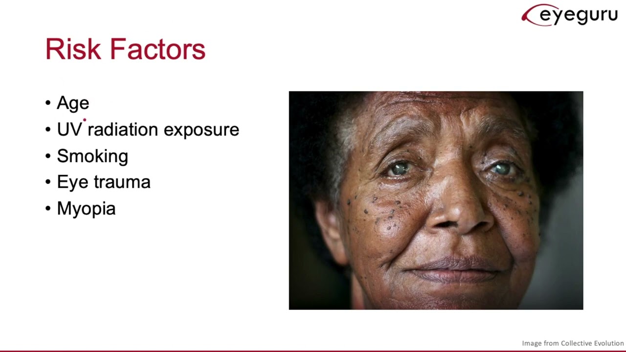 1.2: Nuclear Sclerotic Cataracts