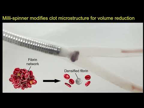 Removing blood clots with milli-spinner