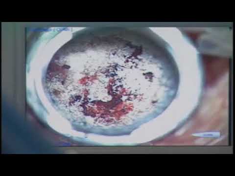 007 Facetectomy