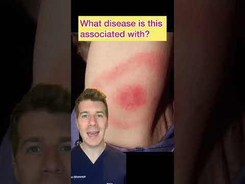 A bullseye rash following a camping trip… 🎯 what’s the diagnosis? #shorts #medical #dermatology