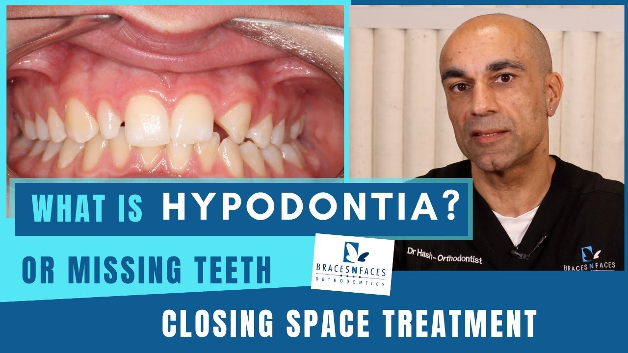 How To Fix Missing Teeth with Braces?
