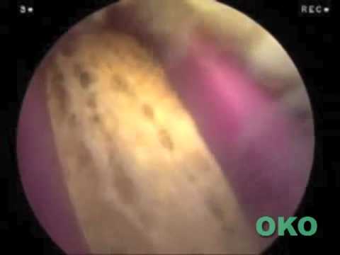 3.2 Arthroscopic Management of Chondral Lesions of the Hip Associated With FAI