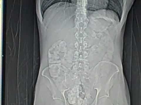 CT ABDOMEN PELVIS