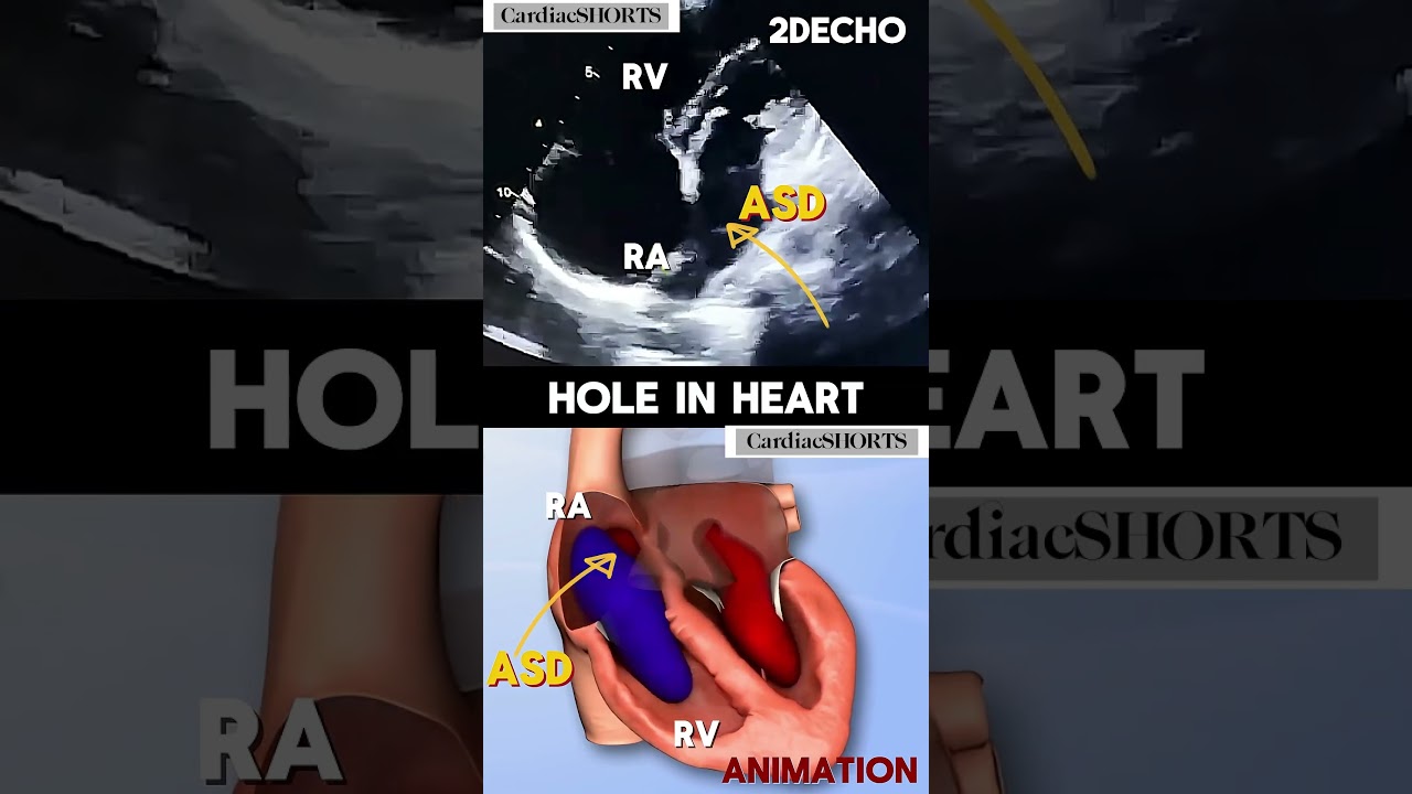 Atrial Septal Defect (ASD) | Hole in Heart (2DEcho vs Animation) #shorts #asd  #echocardiography
