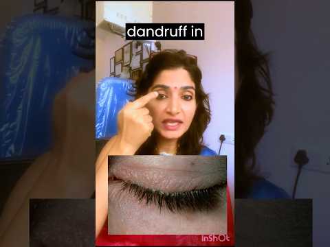 Who knew? Dandruff in the eye | Surprising connection! | Dr Sahebaan Sethi
