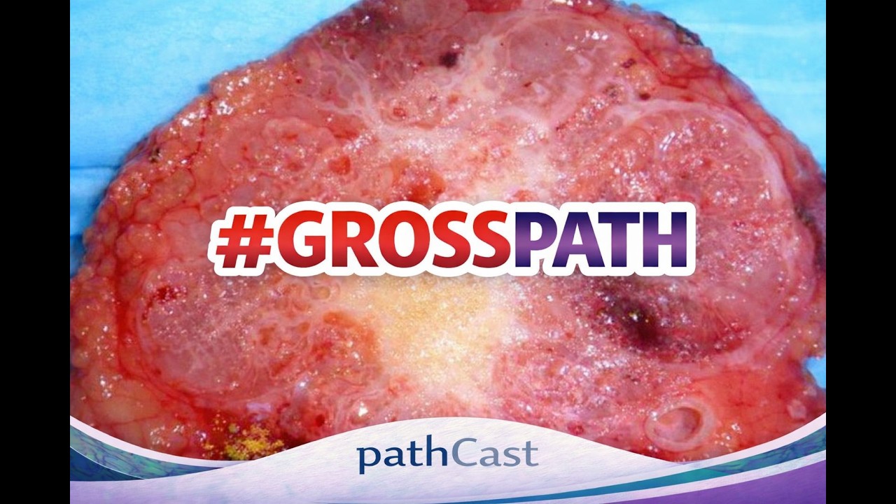 An Introduction to Gross Specimen Examination: Basic Principles #grosspathCast