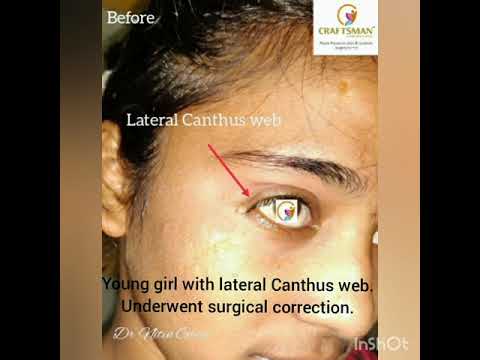 Lateral Canthus web correction - Del Campo tissue transposition technique