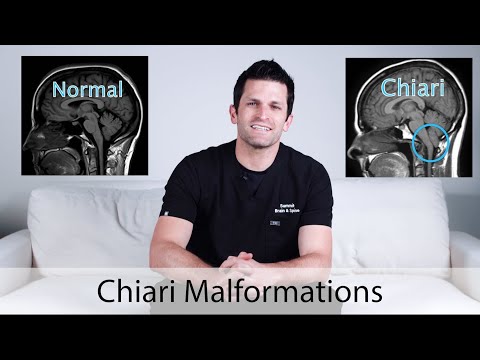 Chiari Malformations