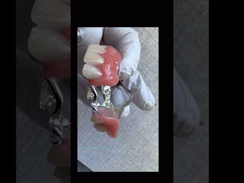 Cast Metal Partial by RanaTannteknikk, Norway. #dental #dentures #teeth #smile #tannproteser