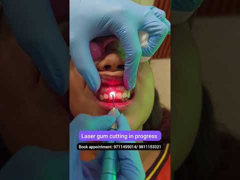 LIVE Laser Gum cutting; Gummy smile treatment; Dr. Srishti Bhatia