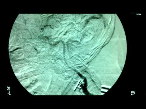 Carotid Endarterectomy(CEA) at Medical Associates Hospital