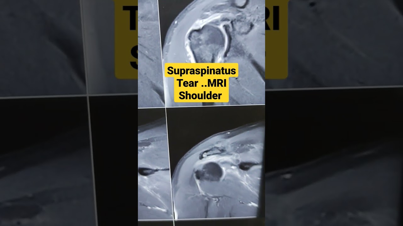 Supraspinatus Tear ..MRI Shoulder ..Dr Sai Chandra..#shoulderpain #shoulderarthroscopy