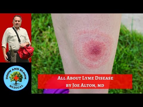 Lyme Disease: Prevention, Symptoms, Stages and Early Treatment