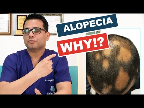What is Alopecia areata ?- Causes, Diagnosis & Hair Re-growth Treatments? @skinqure (in Hindi)