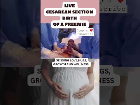 Live cesarean section birth of preemie ❤️ #shorts #shortsfeed #birth #mamalove