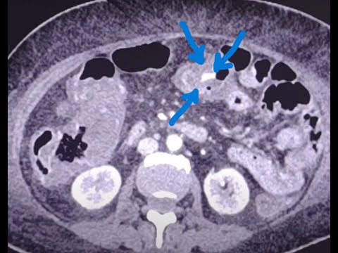 GI BLEED - The importance of the right CT protocol