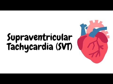 Supraventricular Tachycardia (SVT)