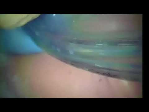 King LTS D placement viewed through KingVision VL