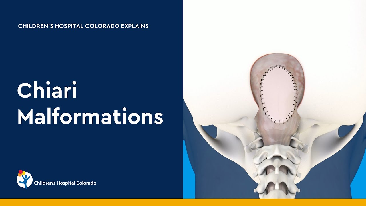 Chiari Malformation and Treatment