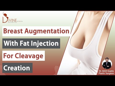 Breast Augmentation with Fat Injection for Cleavage Creation