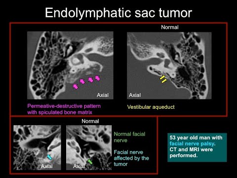 endolymphatic sac tumor ; Definition, Causes, Symptoms, Diagnosis, Treatment