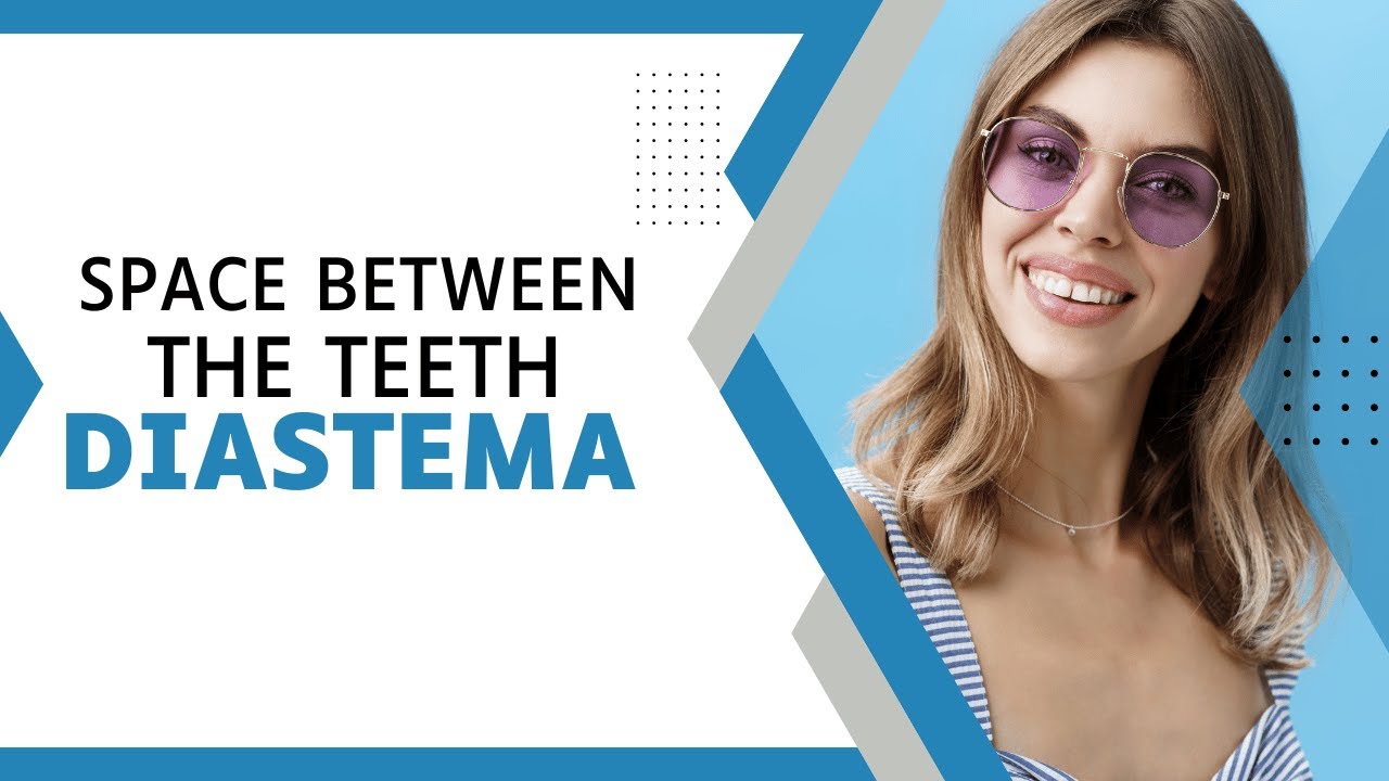 Space Between the Teeth (Diastema) - Causes, Treatment, and Considerations