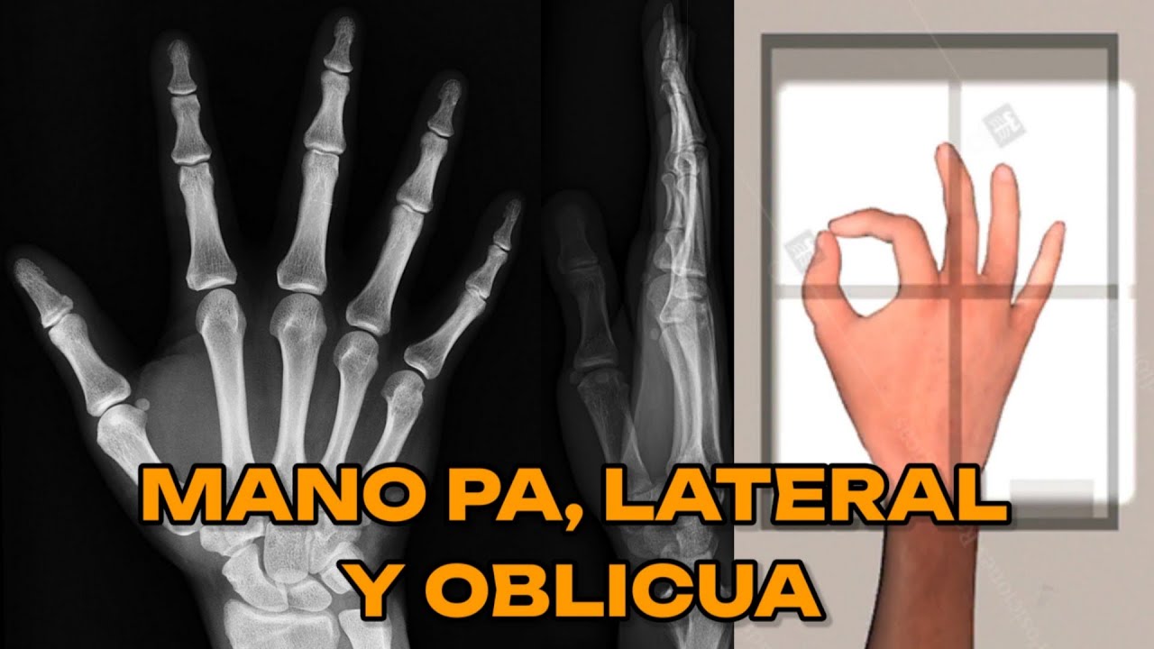 PA, LATERAL AND OBLIQUE HAND X-RAY (POCKET MANUAL) #8