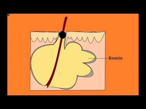 Epidermoid cysts of the skin