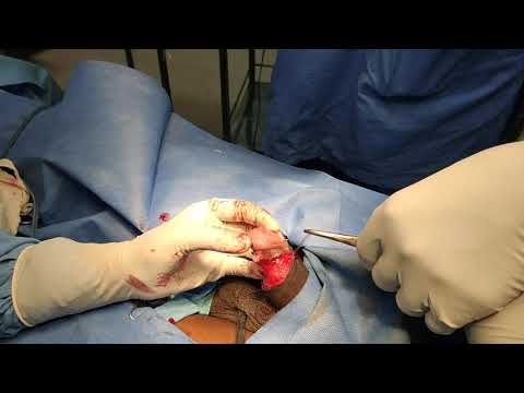 Fully bipolar circumcision technique