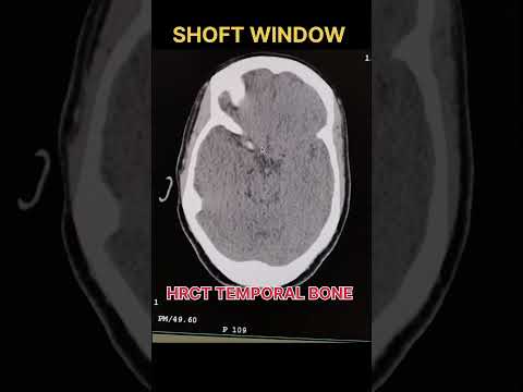HRCT TEMPORAL BONE SOFT AND BONE WINDOW #CT ACAN