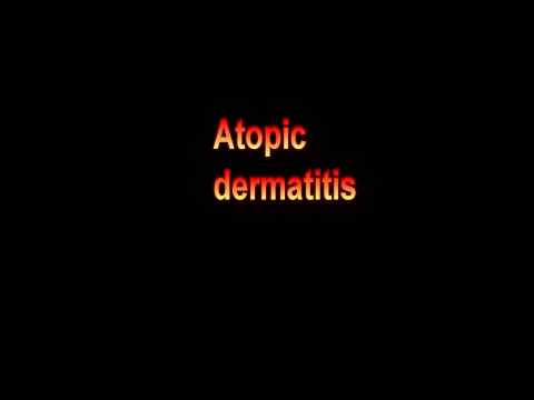 What Is The Definition Of Atopic dermatitis Medical Dictionary Free Online