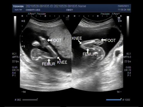 Rocker Bottom foot, a fetal anomaly.