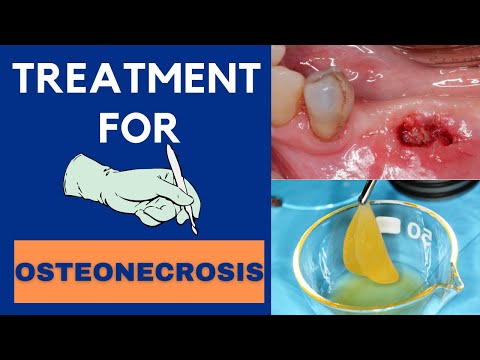 Treatment for bisphosphonate-related osteonecrosis of the jaw - Live surgery