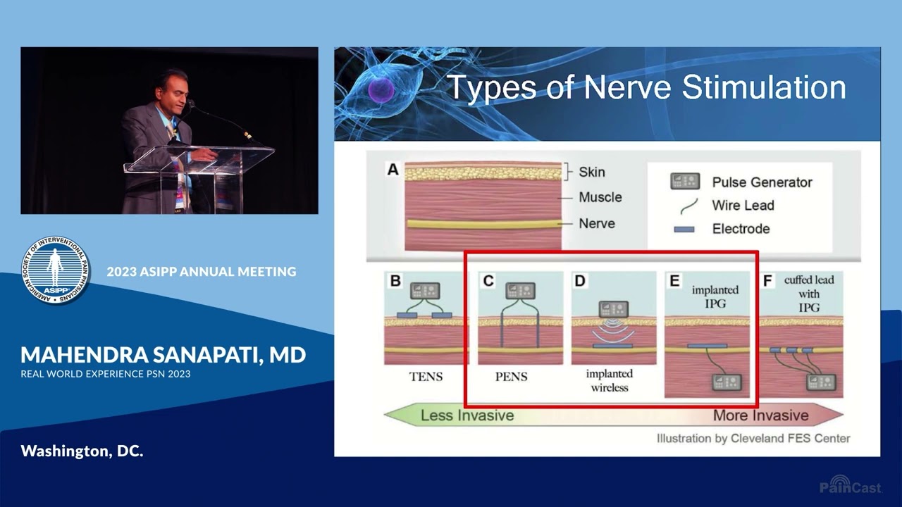 Real World Experience of Peripheral Nerve Stimulation