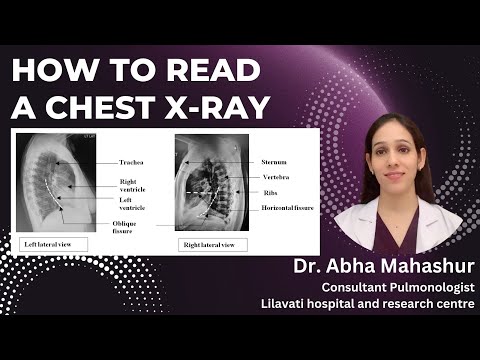 How to read a Chest X-ray - Essential guide to Chest X-ray interpretation - Segments of the lung