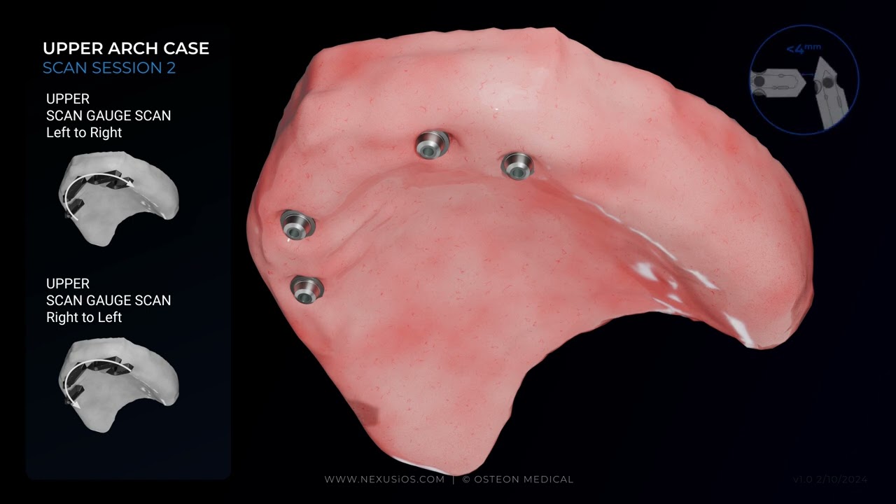 Nexus iOS - Definitive Protocol from Denture - Upper Arch
